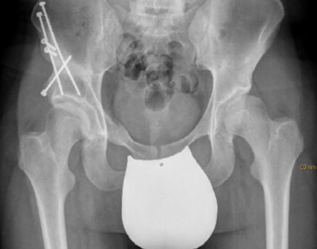 Peri-Acetabuläre Osteotomien (PAO, Beckenosteotomien)