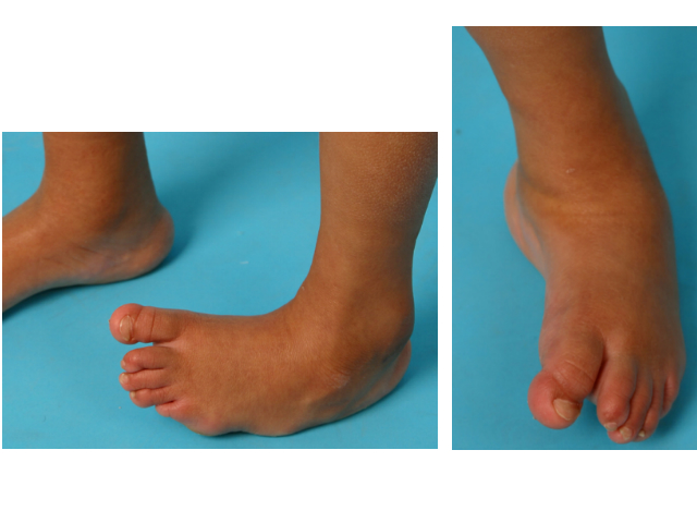 Muskeltransfers und Muskelverlängerungen