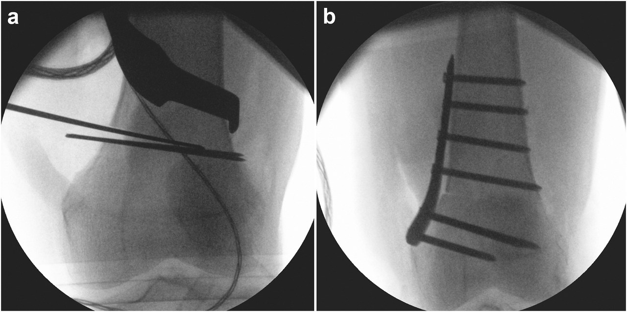 Bony Procedures for surgical patellar stabilization